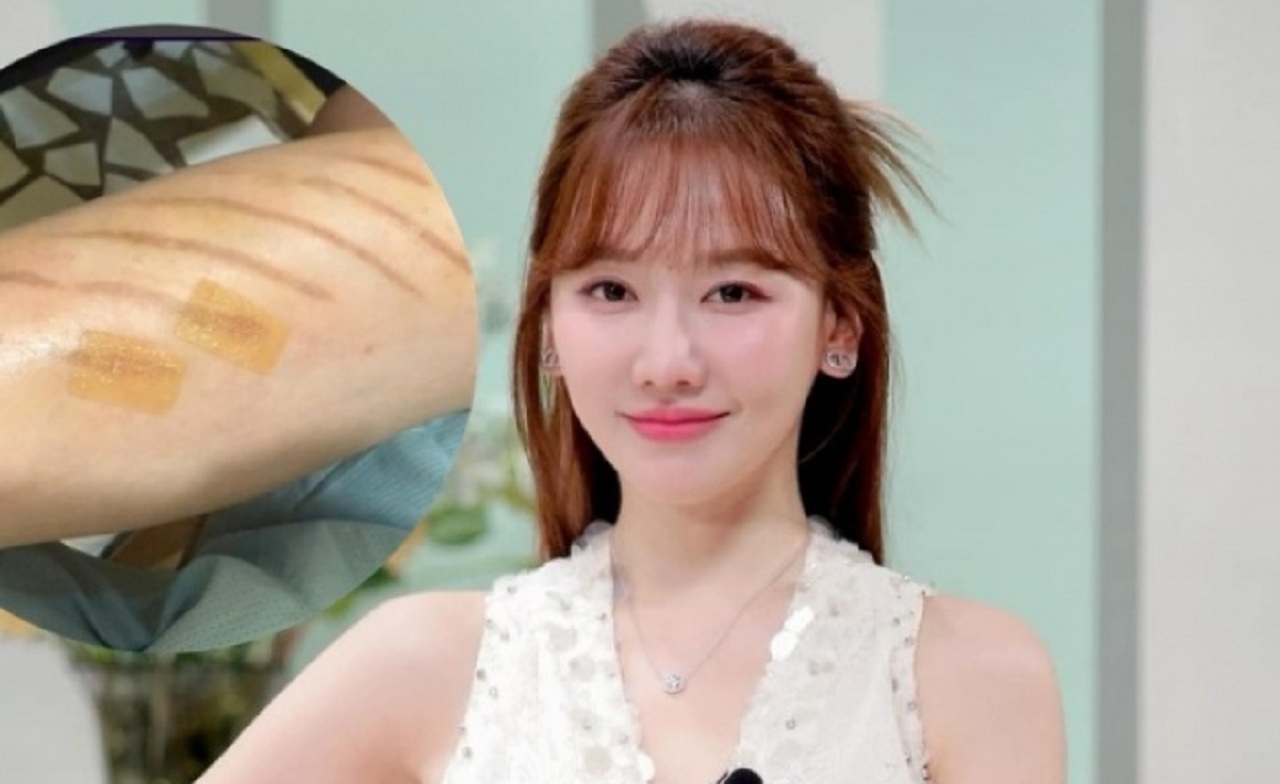 Hari Won tiết lộ tình trạng hiện tại sau khi bị ngã cầu thang cuốn